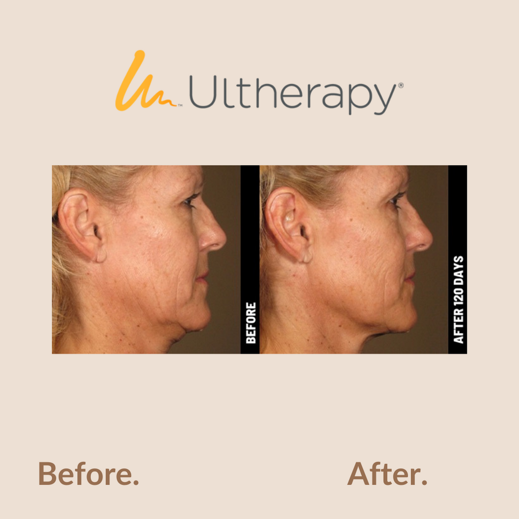 What is Ultherapy Skin Tightening and How much Does it Cost?
