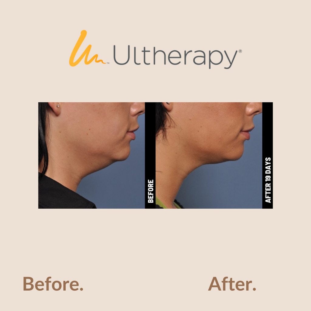 What is Ultherapy Skin Tightening and How much Does it Cost?