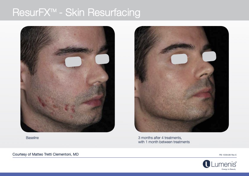 The Lumenis® M22 IPL in Sunny Isles Beach, FL | Skin Rejuvenation